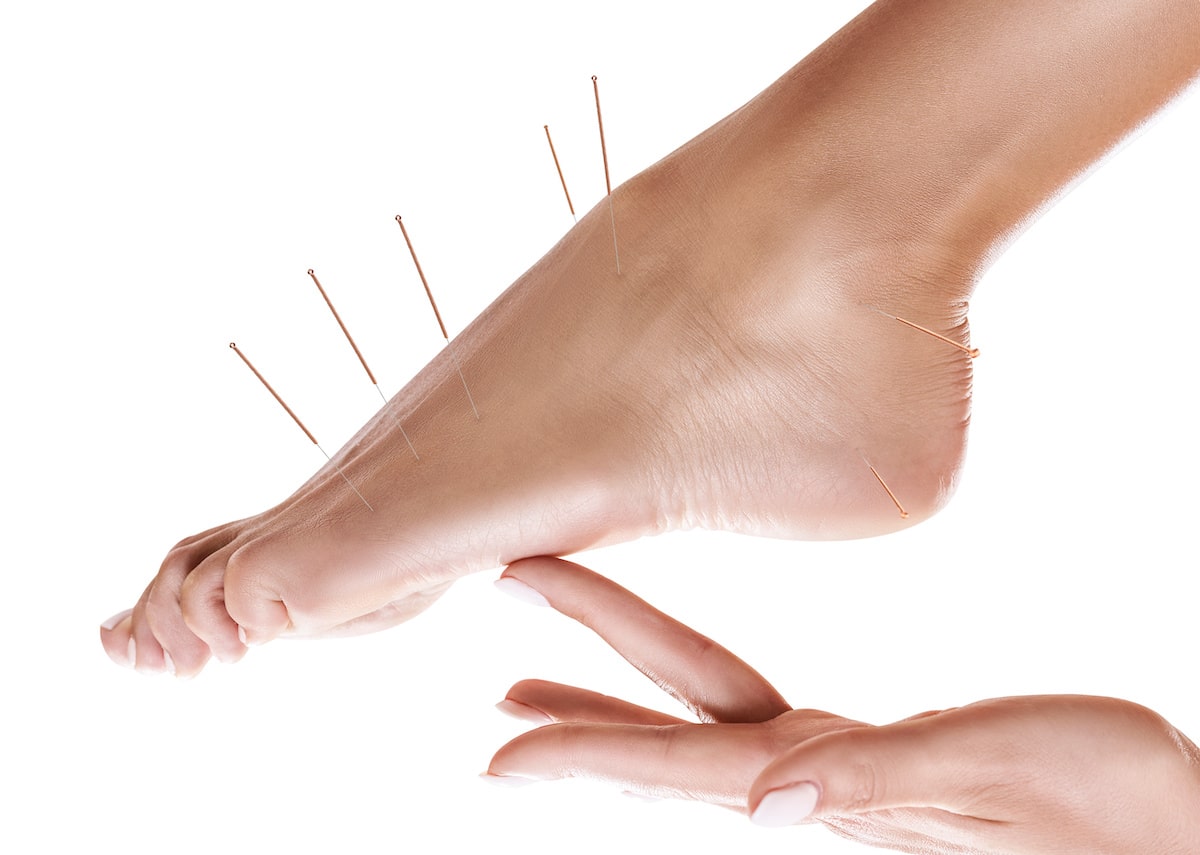 Can Acupuncture Help Peripheral Neuropathy?